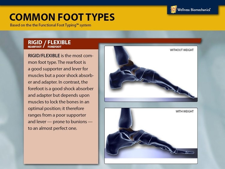 PTTD What Is The Foot Type PTTD What Is The Foot Type