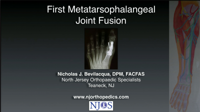 First Metatarsophalangeal Joint Fusion